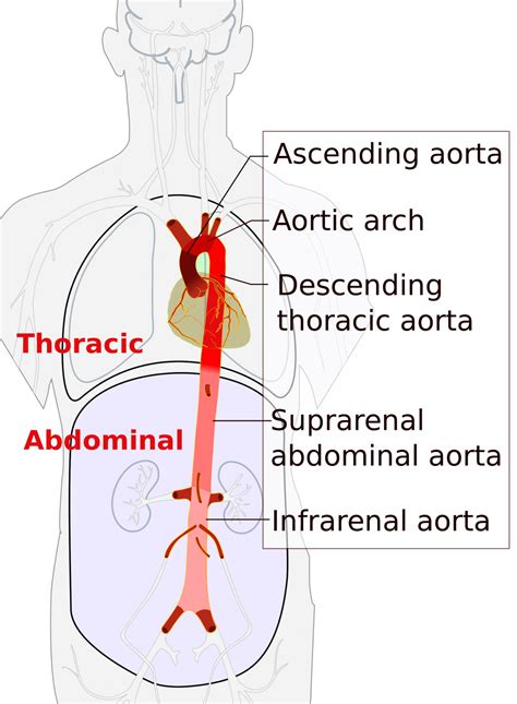 Image result for Type 2 Aortic Dissection