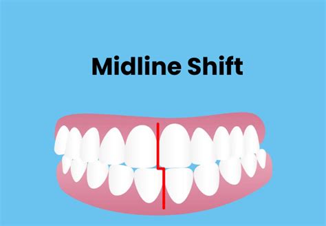 Image result for How to Remove Midline