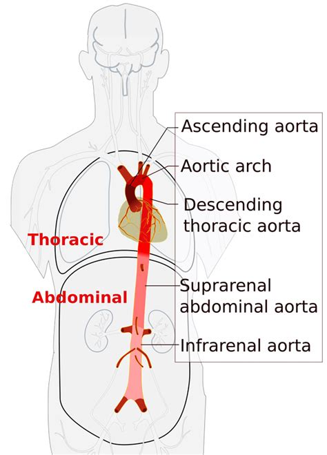 Image result for Type 2 Aortic Dissection