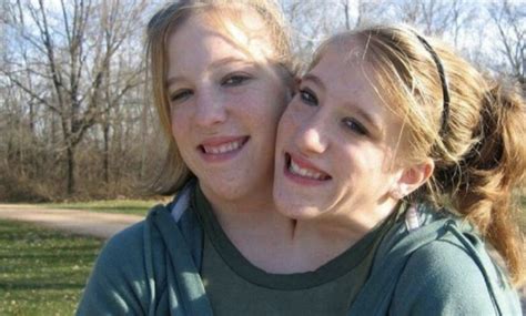 Image result for Java Island Siamese Twins