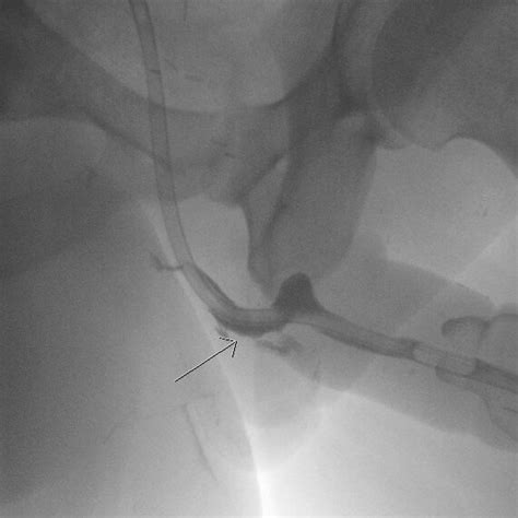 Image result for Urethrogram Technique