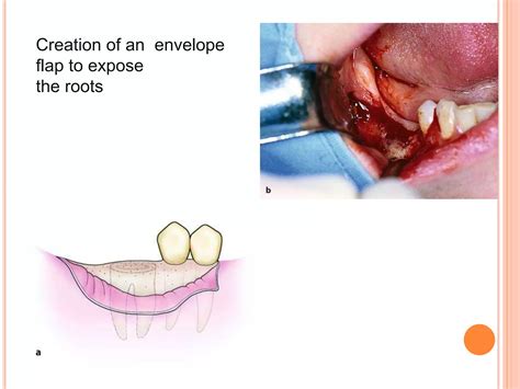 Image result for Principles of Tooth Extraction