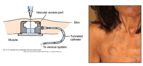 Image result for IV Line Infiltration