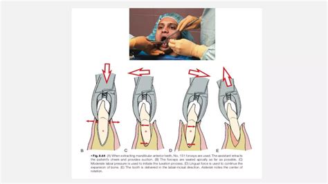 Image result for Principles of Tooth Extraction