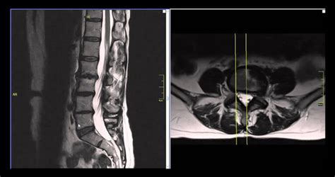 Image result for How to View MRI Disc