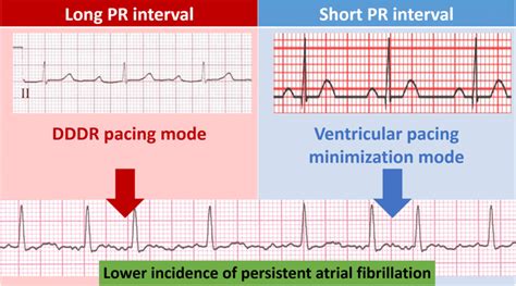 Image result for PR Interval Abnormalities