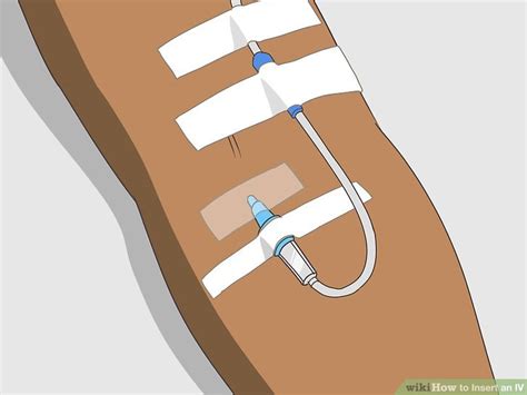 Image result for Insert IV Line