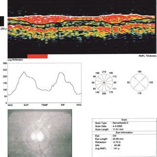 Image result for Normal OCT Scan