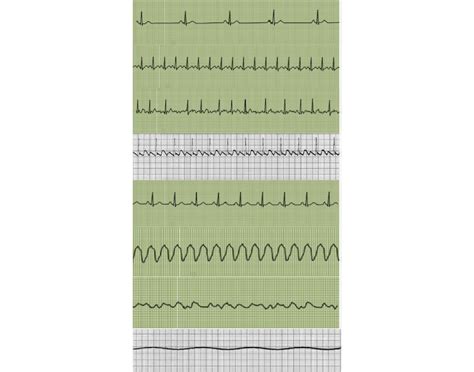 Image result for ECG Reading Practice