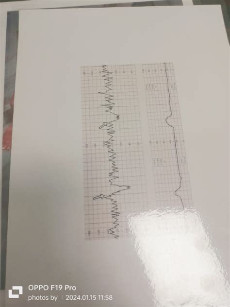 Image result for CTG and Partogram