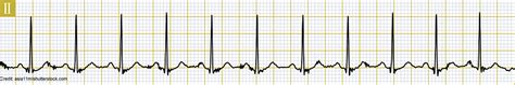 Image result for ECG Reading Practice