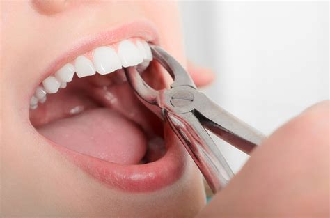 Image result for Tooth Extraction Process