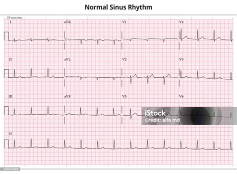 Image result for Normal EcG