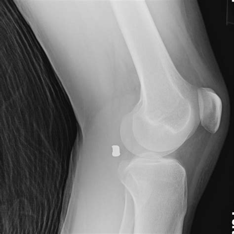 Image result for Left Lower Extremity Angiogram