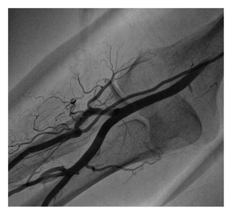 Image result for Angiogram Radial