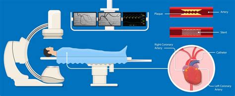 Image result for Different Types of Angiogram