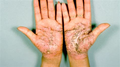 Image result for Types of Pustular Psoriasis
