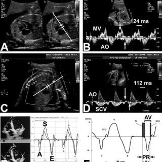 Image result for Normal PR Interval Fetus