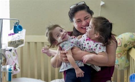 Image result for Java Island Siamese Twins