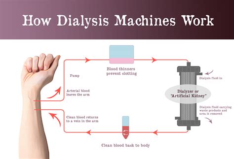 Image result for How Does a Dialysis Machine Work