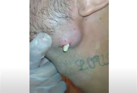 Image result for Big Exploding Cyst Neck