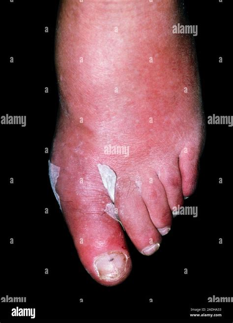 Image result for Cellulitis Toe