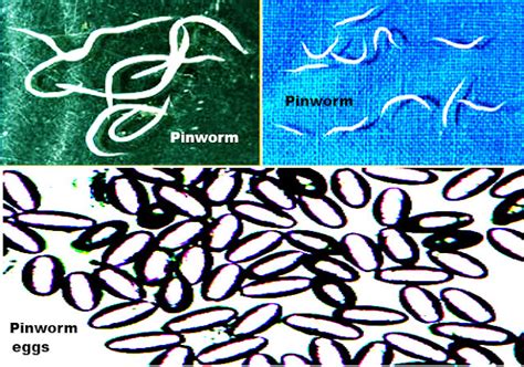 Image result for Pinworm Skin