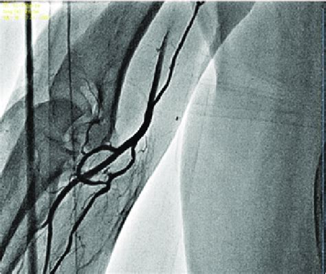 Image result for Radial Loop Angiogram