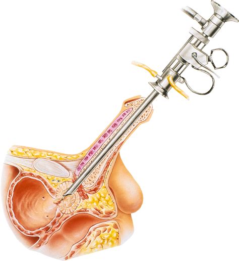 Image result for Prostate Operation Procedure