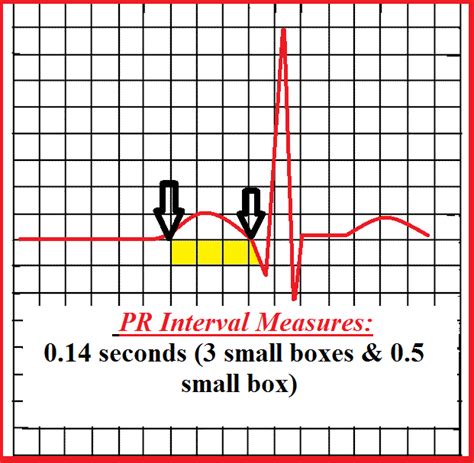Image result for PR Interval ECG