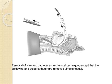 Image result for Retrograde Intubation
