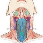Image result for Types of Neck Dissection