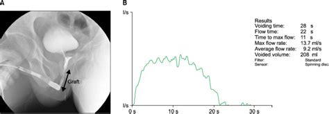 Image result for Urethrogram Technique
