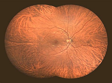 Retinal Imaging – Optometrist / Eye Doctor in Toronto | Clairhurst Eye Care