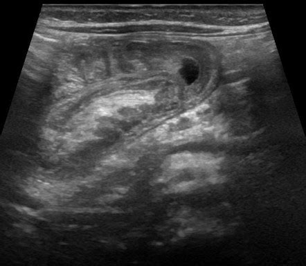 Image result for Intussusception Pseudokidney Sign