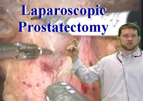 Image result for Prostatectomy Surgery Procedure