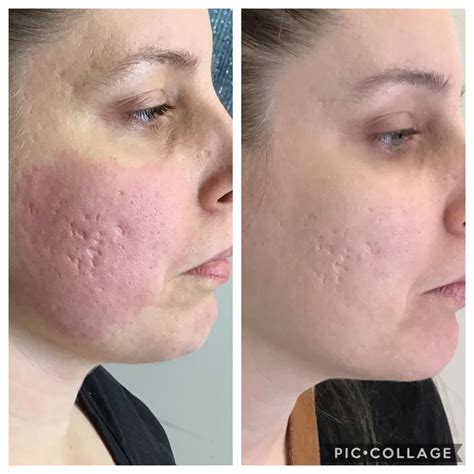 Image result for Skin Threading