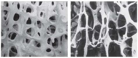 Image result for Trabecular Bone Structure