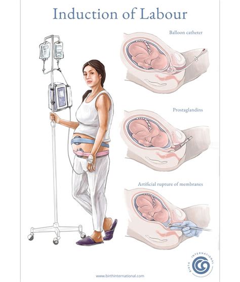 Image result for Inducing Labor Procedure