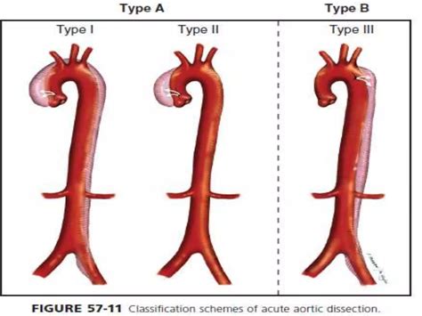 Image result for Type 2 Aortic Dissection