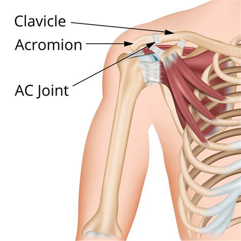 Image result for AC Joint Dysfunction