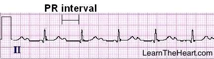Image result for AV Block PR Interval