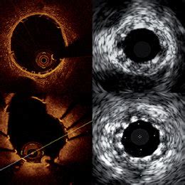 Image result for Oct Axial Resolution