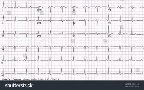 Image result for Normal EcG