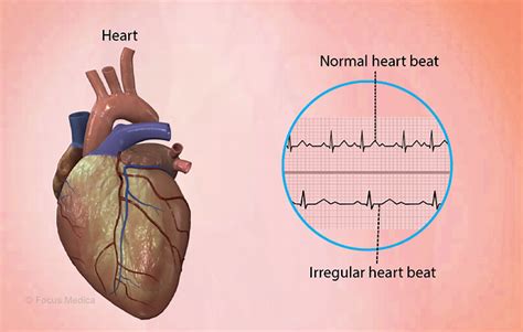 Image result for Heart Block Angiogram