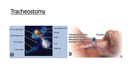 Image result for Intubation PowerPoint Presentation