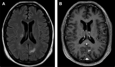 Central Nervous System Vasculitis - Rheumatic Disease Clinics - Face ...