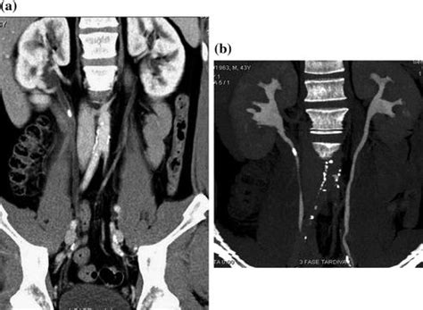 Image result for Urogram CT Scan with Contrast Normal