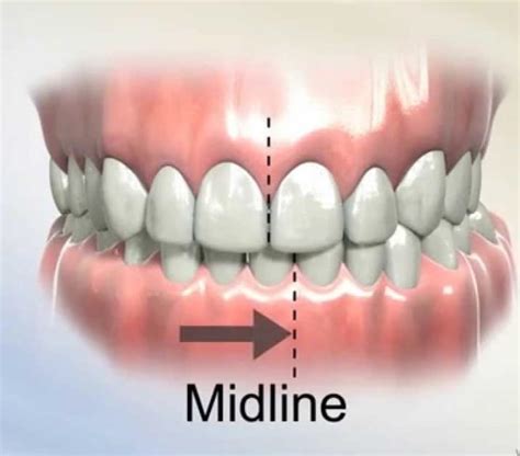 Image result for How to Remove Midline