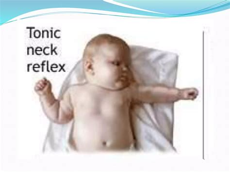 Image result for Neonatal Primitive Reflexes